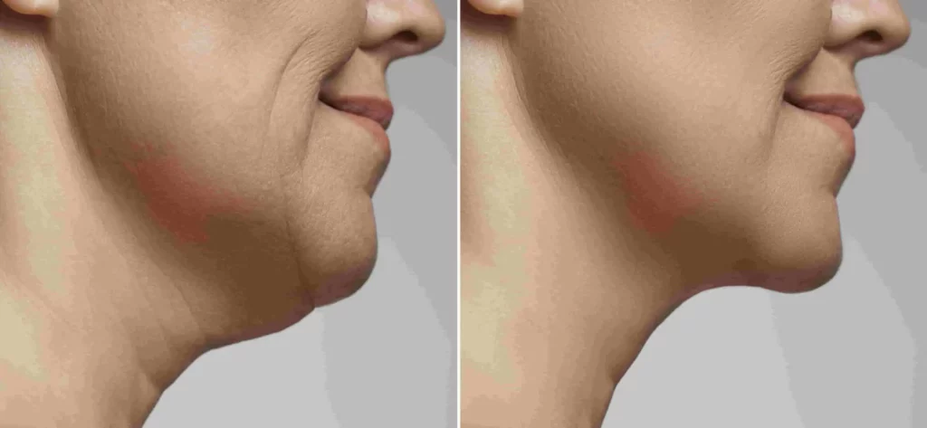 Your Jawline and Chin: Exploring Techniques and Benefits